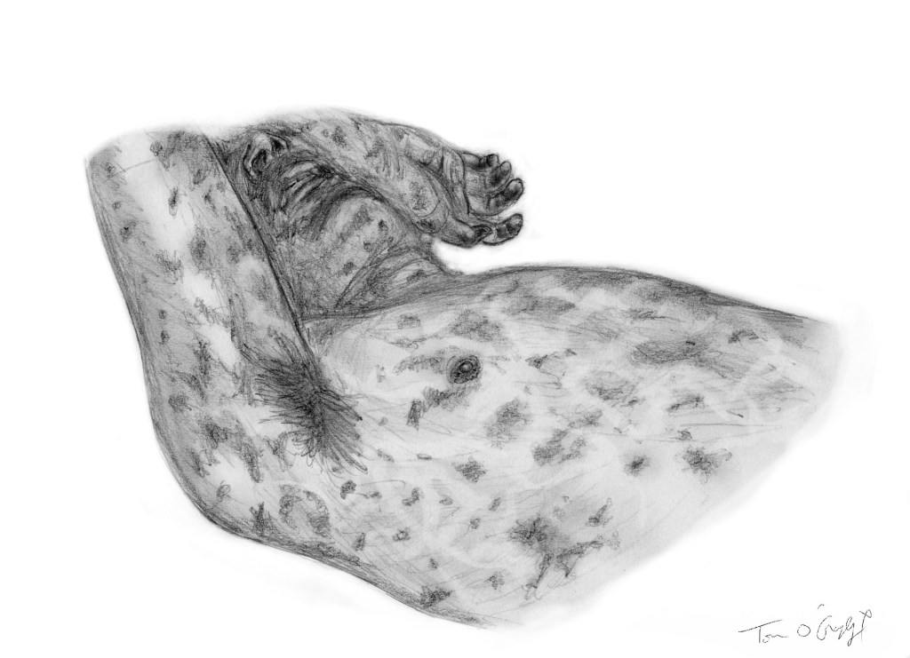 Septicémie, sepsis grave et choc septique | thoracotomie