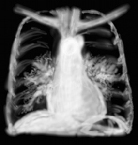 Interprétation d’une radiographie thoracique en urgence – 3 – opacités ...