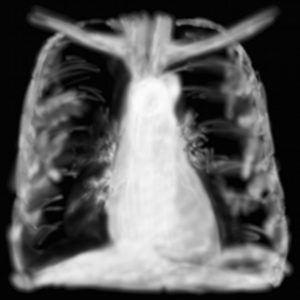 Interprétation d’une radiographie thoracique en urgence – 2 – la plèvre ...