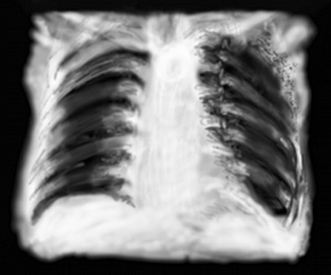 Interprétation d’une radiographie thoracique en urgence – 5 – parois ...