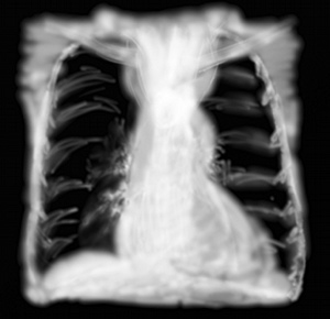 Interprétation d’une radiographie thoracique en urgence – 1 – le ...