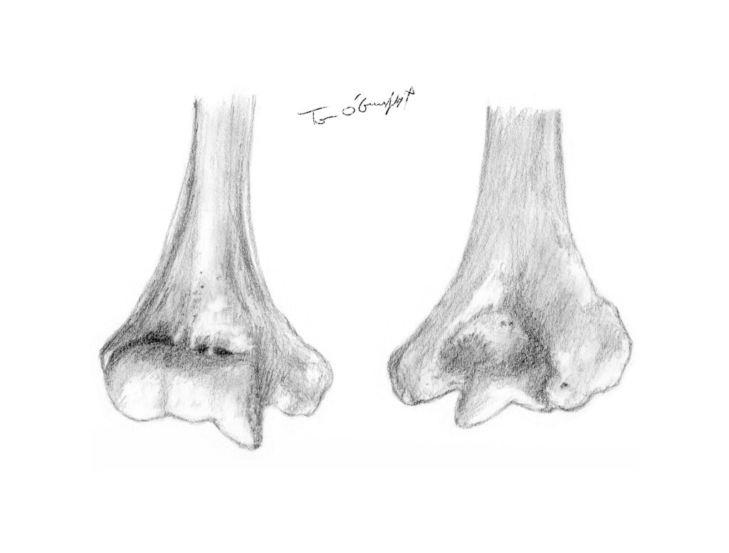 Fractures de la palette humérale | thoracotomie