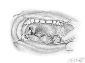 Abcès et phlegmon péri-amygdalien | thoracotomie