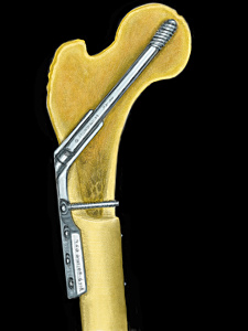 DHS femur | thoracotomie