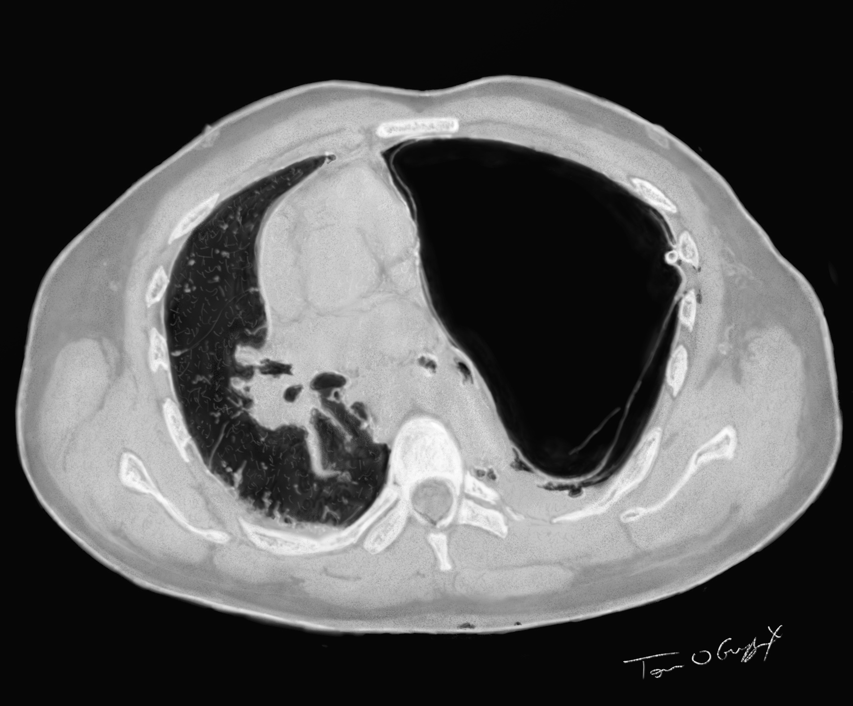 scanner bulle emphyseme drain thoracique | thoracotomie